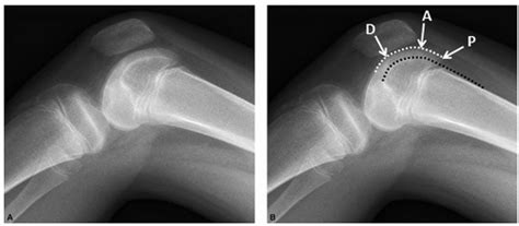 Lateral Facet Elevating Trochleoplasty Musculoskeletal Key