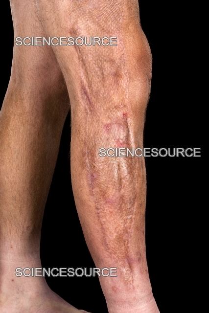 Healed Leg After Necrotizing Fasciitis Stock Image Science Source Images