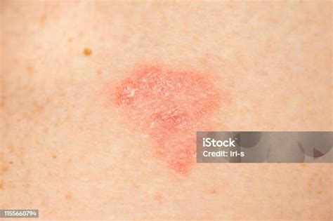 피부 클로즈업에 알레르기 성 발진 건선 아토피 성 피부염 습진 피부 증상 소프트 포커스 선택한 초점 습진에 대한 스톡 사진 및 기타 이미지 Istock