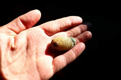 Premium Photo Gallstone Disease Cholelithiasis The Formation Of