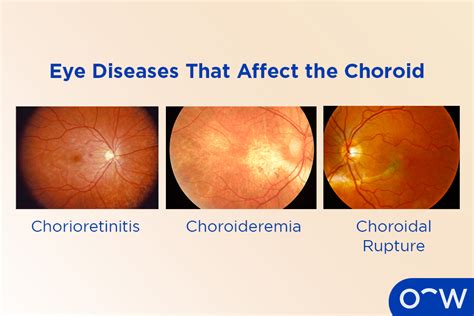 Choroid Anatomy Function And Associated Eye Diseases