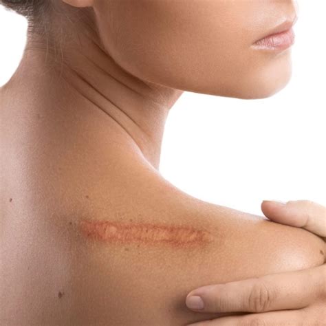 Keloid Treatment Klinik Kecantikan Bianca