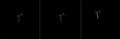 Mrcp Shows Type 3a Anatomic Variant Of The Biliary Tree Download Scientific Diagram