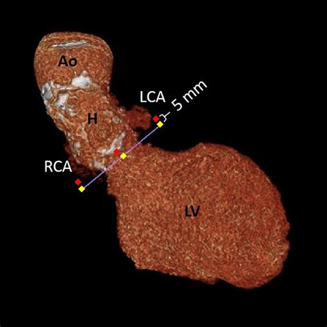 Computed Tomography‐based Reconstruction Of The Lv And Proximal Part Of