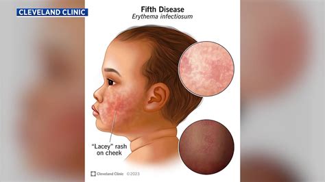5th Disease Also Known As Slapped Cheek Outbreak Suspected At