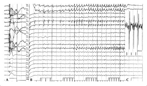 John Libbey Eurotext Epileptic Disorders Extreme Startle And