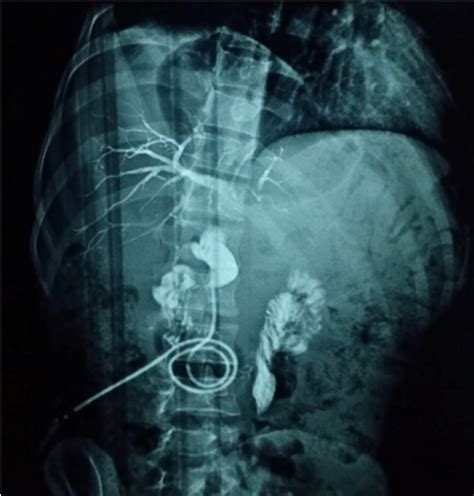 Postoperative Cholangiography Through The Kehr Drain Showing Good Download Scientific Diagram