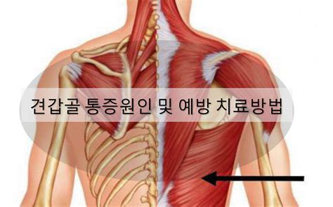 견갑골 통증원인 및 예방 치료방법 호율안 [소소한 이야기]