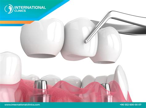 Dental Bridges Vs Implants Which Option Is Right For You