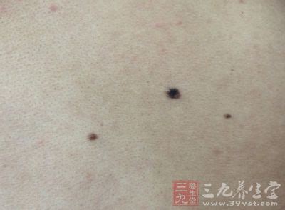 脸上的痣会癌变吗