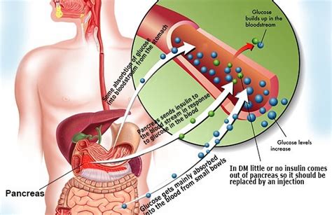 All About Diabetes Gluxus Health Comfortaid