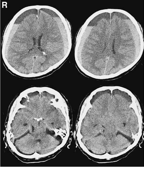 Preoperative Computed Tomography Scans Showing Thick Bilateral Chronic