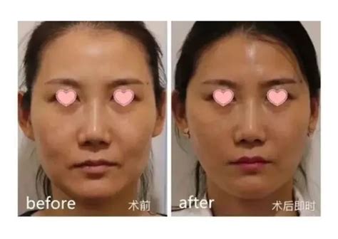超声刀效果怎么样超声刀术后护理怎么做 哔哩哔哩