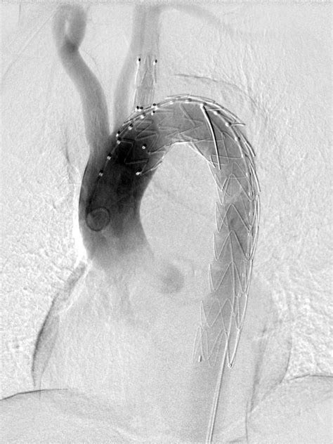 NeuAngio 43C Aortic Arch Angiography Neusoft Medical Latinoamérica