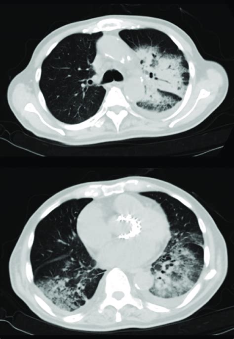 Chest Computed Tomography Images Are Consistent With The Findings From