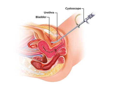 Diagnostic Cystoscopy Indo Taj Medical Center