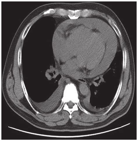 Computed Tomography Scan Showing The Pericardial Effusion Download Scientific Diagram