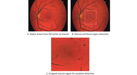 Animal Model Diabetic Macular Edema At Shelley Morgan Blog