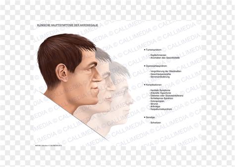 Nose Acromegaly Symptom Pituitary Gland Medical Sign Png Image Pnghero