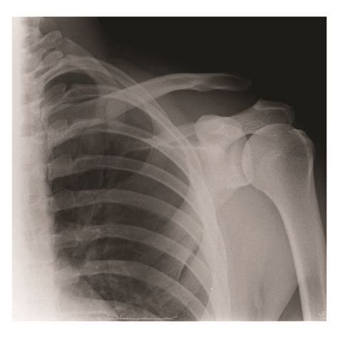 Anteroposterior Left Acj Radiograph Demonstrating Rockwood V Acj