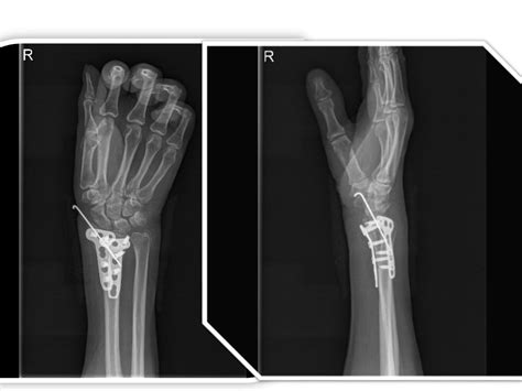桡骨颈图片桡骨骨折图片桡骨图片大山谷图库