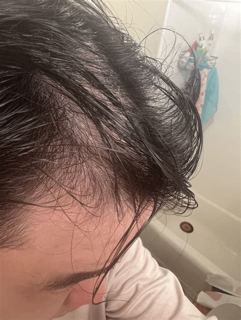 6 Month Diffuse Thinner Update 23yo Korean Rtressless