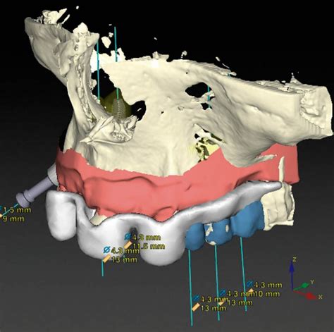 Elevación del seno maxilar y colocación de implantes inmediatos Gaceta Dental