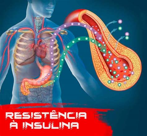 Resistência A Insulina é Uma Das Principais Causas De Doenças Veja