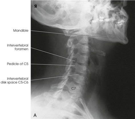 Cervical Spine Positioning Flashcards Quizlet
