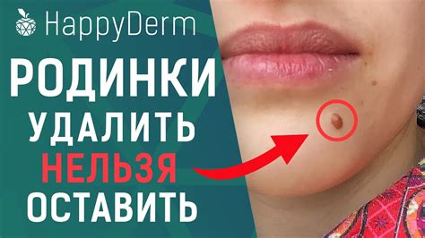 КАК УДАЛИТЬ РОДИНКУ ЛАЗЕРОМ ИЛИ ХИРУРГИЧЕСКИ КАК РАСПОЗНАТЬ МЕЛАНОМУ