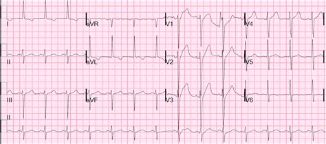 Dr Smiths Ecg Blog Is There St Segment Depression Here