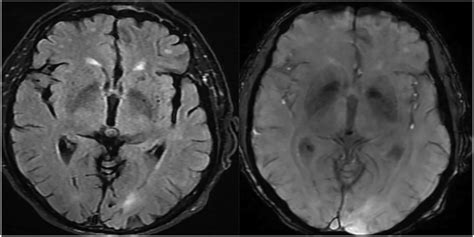Mri Study In Chronic Obstructive Pulmonary Disease Copd Patients With