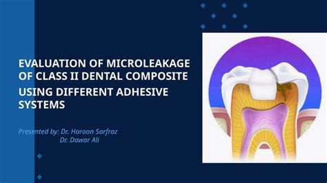 Comparison Of Microleakage In Class 2 Dental Composite Using Self Etch And Total Etch Pptx