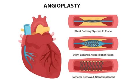 Angiogram Vs Angioplasty Understanding The Key Differences