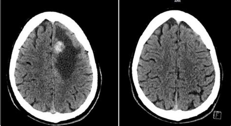 Terminal Brain Cancer Alkaline Diet United States Dr Robert Young
