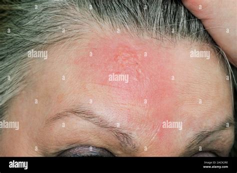 Not For Use In Television Not For Use In Television Shingles Rash On The Forehead In An Adult