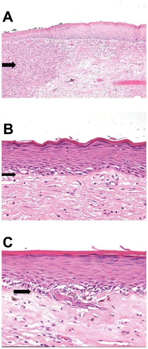 Vulvar Melanoma Cancer