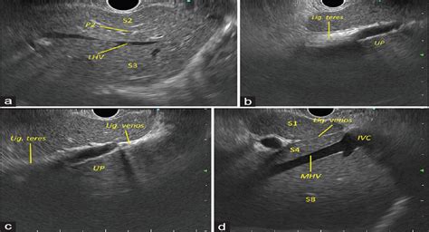 Eus Anatomy Of The Liver Segments Endoscopic Ultrasound