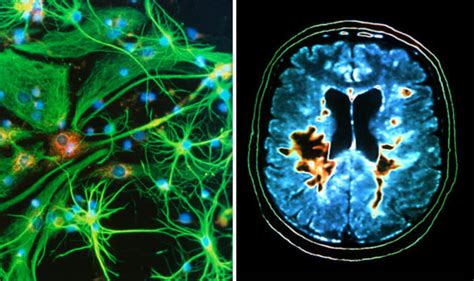Multiple Sclerosis What Are Astrocytes Cell Now Key To Brain