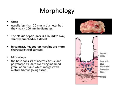 Lectures Gastro Esophageal Reflux Disease Peptic Ulcer Disease Ppt