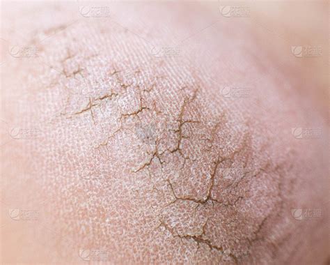 一个人的脚后跟干燥皲裂的皮肤，特写。概念严重的皮肤病和真菌感染，宏观，代谢过程