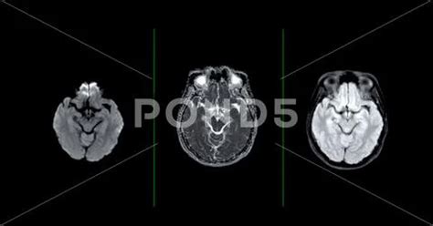 MRI Brain Scan Axial Diffusion Technique For Detect Brain Diseases Sus Illustration 250175692
