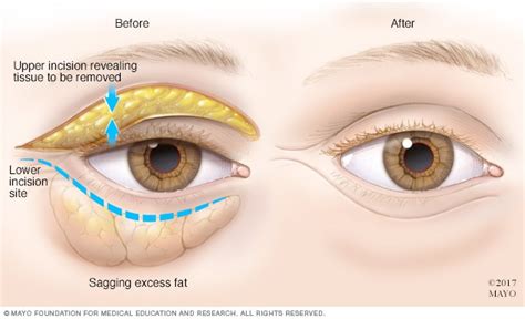How To Get Rid Of Puffy Eyes Get Rid Of Swollen Eyes Eye Bag Treatment Swellnomore