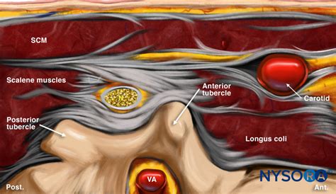 Ultrasound Guided Cervical Nerve Root Block Nysora