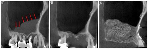 Floor Of The Nasal Cavity Radiograph