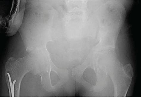 A B Case 2 14 Years Old With Development Of Left Acetabular