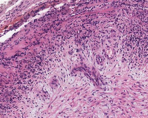 Neoangiogenesis Gca Histology