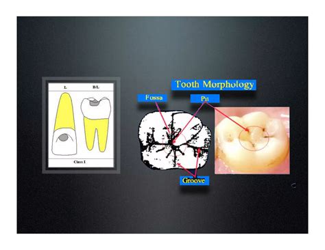 Amalgam Cavity Preparation Class I Pdf