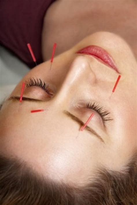 Acupuncture For Sinus The Acupuncture Clinic