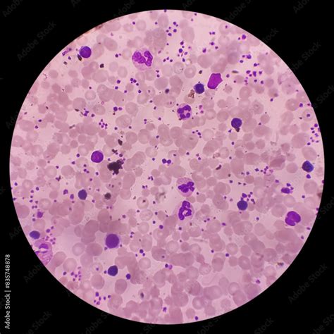 Bone Marrow Study Bms Chronic Hyper Eosinophilic Syndrome Hypo And